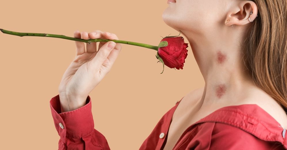 20 Tested Tips For How to Get Rid of a Hickey - The Habitat