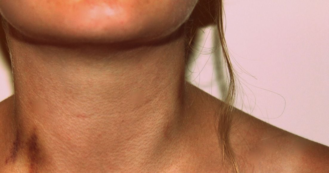 How to Get Rid of a Hickey - The Habitat