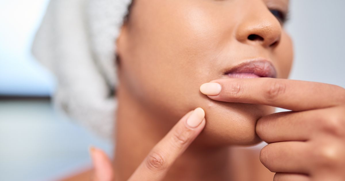 10 Effective Treatments for Quick Pimple Relief - The Habitat
