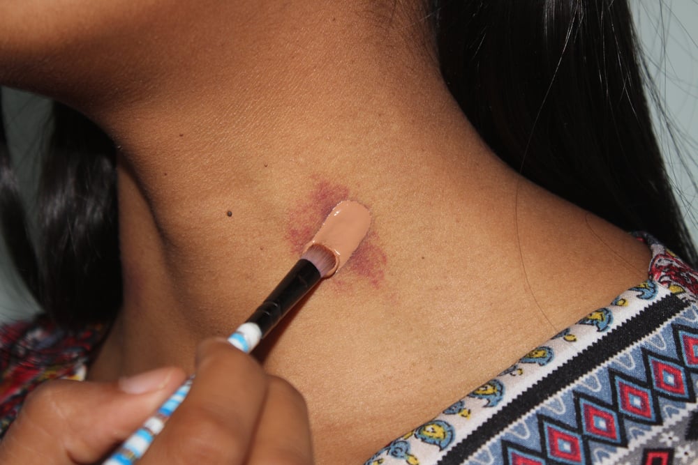 20 Tested Tips For How to Get Rid of a Hickey - The Habitat