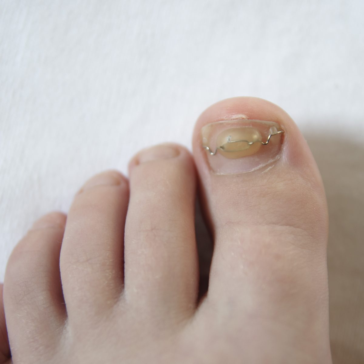 15 Steps to Fix an Ingrown Toenail - The Habitat